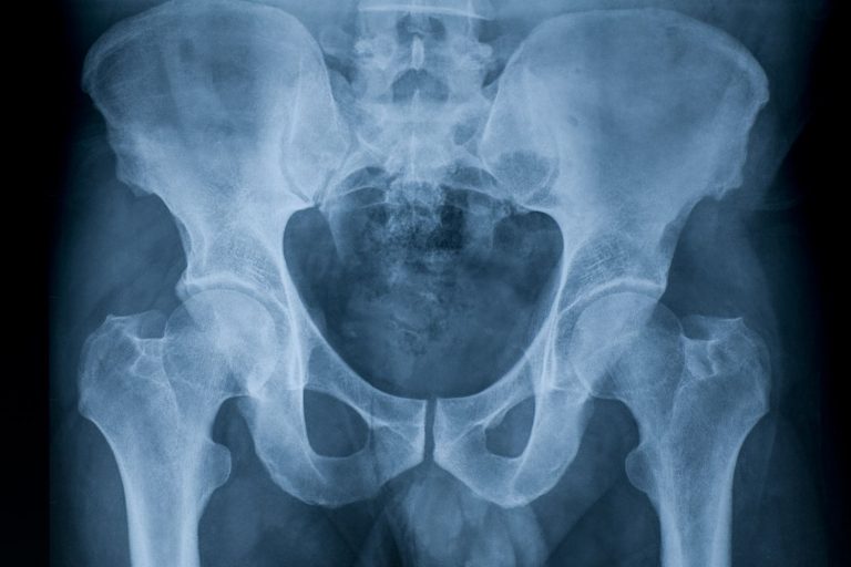Hip Injuries - Cork Surgery - Orthopaedic & Sports Medicine Surgery